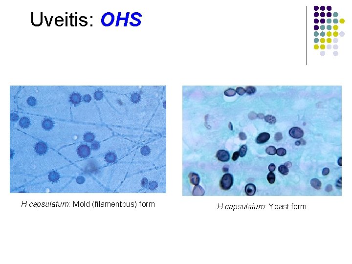 Uveitis OHS Histo Basics 1 The uveitis is