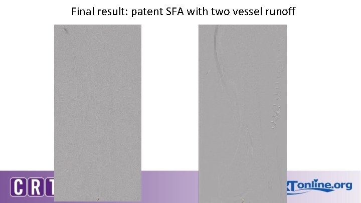Dissection and Intramural Hematoma after Drug Eluting Balloon