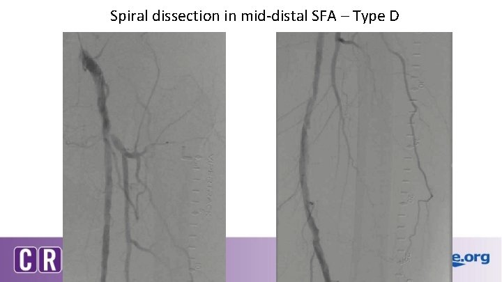 Dissection and Intramural Hematoma after Drug Eluting Balloon