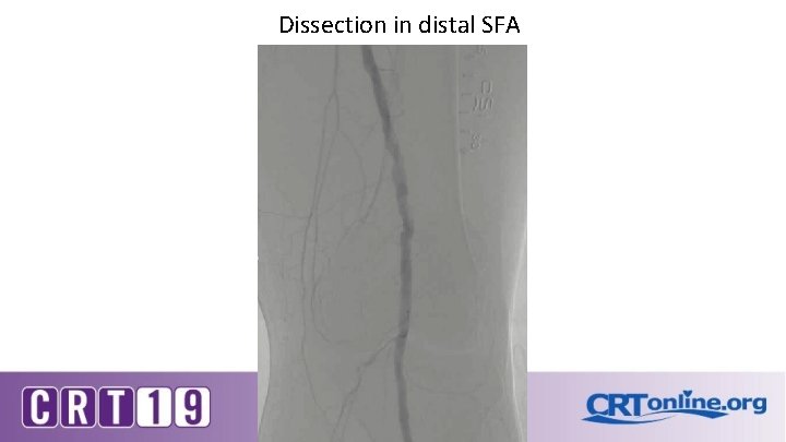 Dissection and Intramural Hematoma after Drug Eluting Balloon