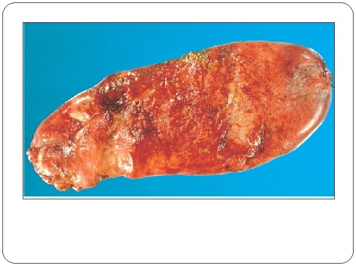 PATHOLOGY AND PATHOGENESIS OF CHOLECYSTITIS Pathology and pathogegenesis