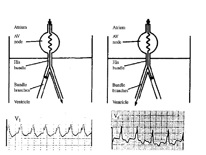 Differential diagnosis of broad complex tachycardia Dr Deepak