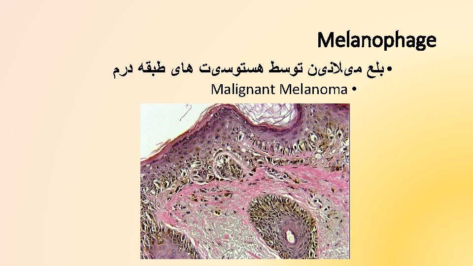 Histopathologic Dr Mohammad Arif Abid dermatologist Hyperkeratosis Wart