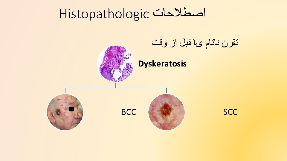 Histopathologic Dr Mohammad Arif Abid dermatologist Hyperkeratosis Wart