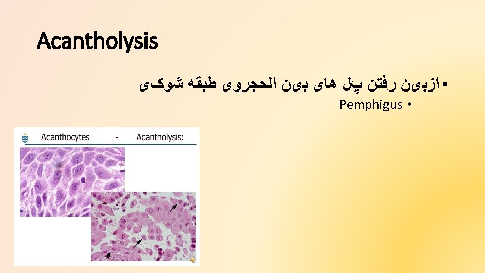 Histopathologic Dr Mohammad Arif Abid dermatologist Hyperkeratosis Wart