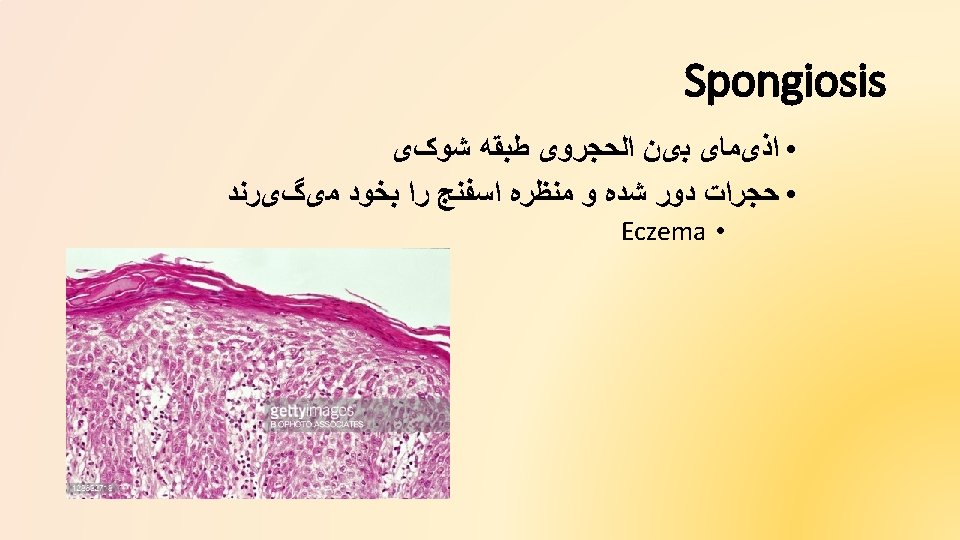 Histopathologic Dr Mohammad Arif Abid dermatologist Hyperkeratosis Wart