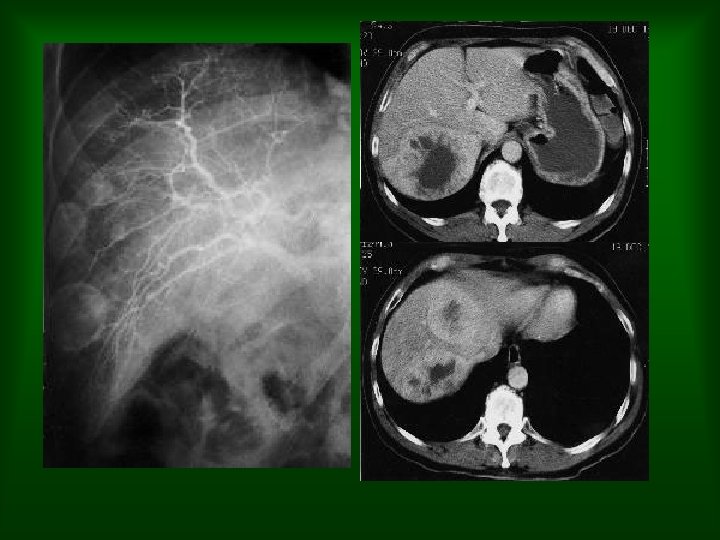 METASTASIS HEPTICAS El hgado es el principal asiento