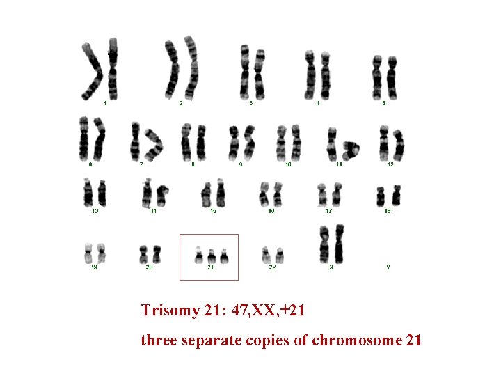 Trisomy 21 47 XX 21 three separate copies