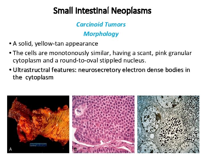 GNB Pathology 2019 Colonic tumors and polyps2 Malignant