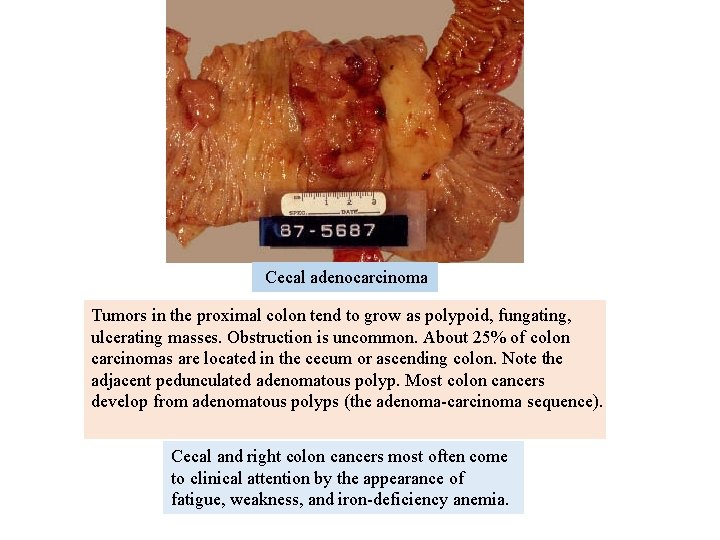 GNB Pathology 2019 Colonic tumors and polyps2 Malignant