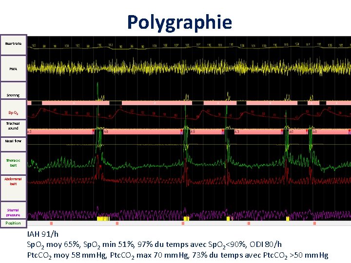 Cas cliniques Sonia Khirani Unit de Ventilation Noninvasive