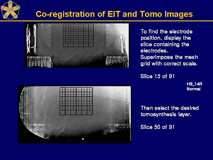 Electrical Impedance Tomography with Tomosynthesis for Breast Cancer