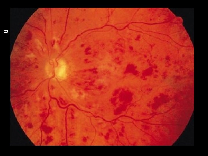 OCCLUSIVE VASCULAR DISORDERS OF THE RETINA CRVO AYESHA