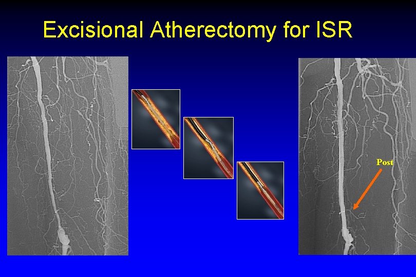 Instent Restenosis and Occlusion Time for Surgical Revision