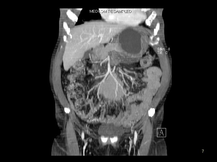 PANICULITIS MESENTRICA Descrita por 1 vez en 1924