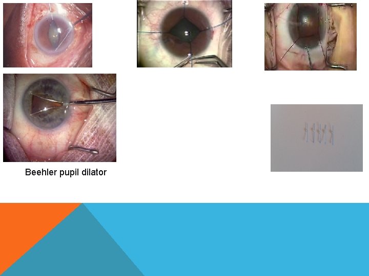 CATARACT SURGERY WITH CHRONIC UVEITIS PREPARE BY HANG