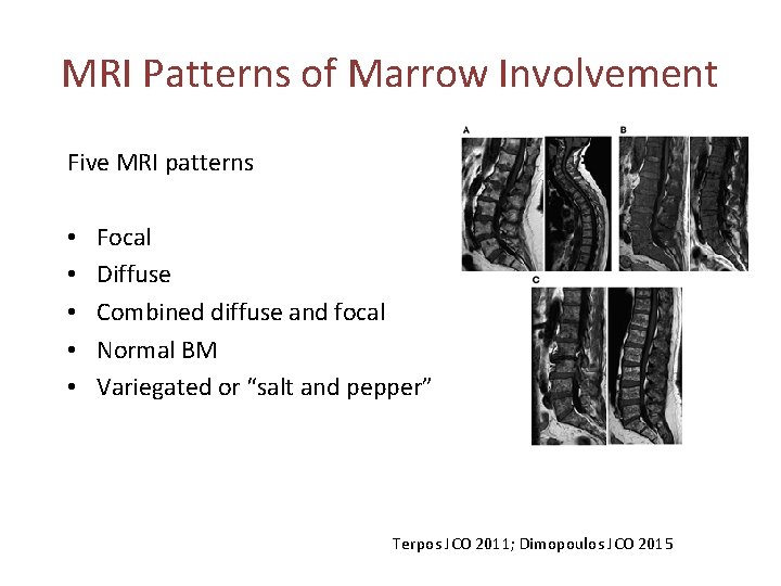 Whole Body Magnetic Resonance Imaging in Newly Diagnosed