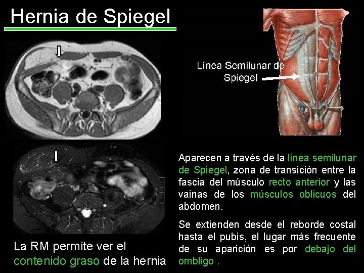 Hernias Externas Hernias externas Spiegel Petit Umbilical Incisional