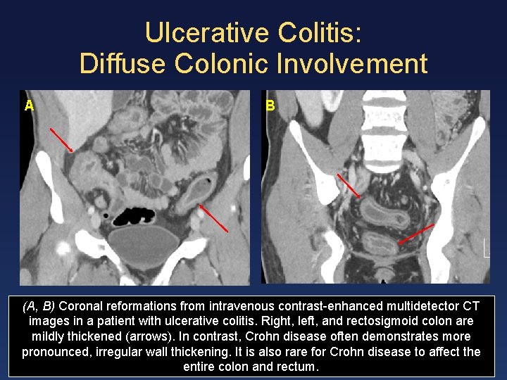 CT Evaluation of Acute Enteritis and Colitis Is