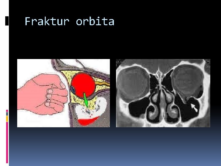 ORBITA PALPEBRA SKLERA KONJUNGTIVA AIRMATA DR NUR SHANI
