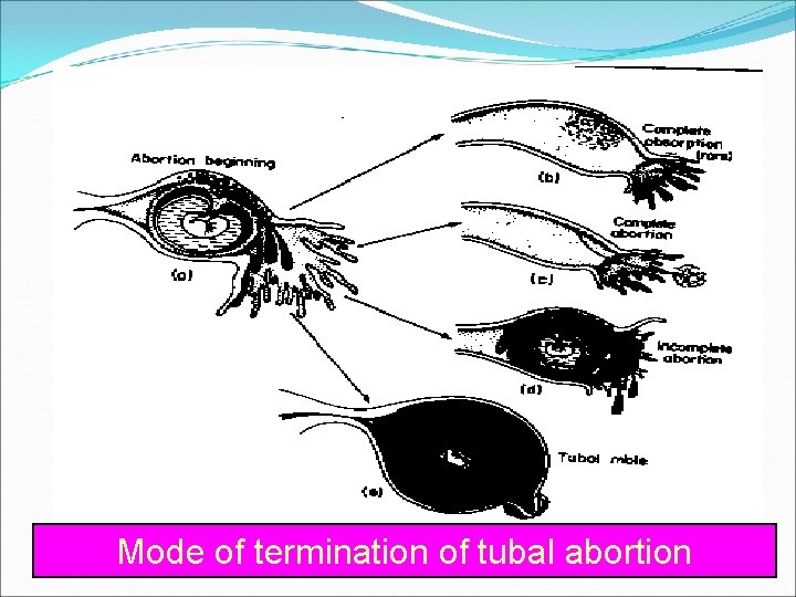 ECTOPIC PREGNANCY Dr Rupa Bajagain Kathmandu Medical College