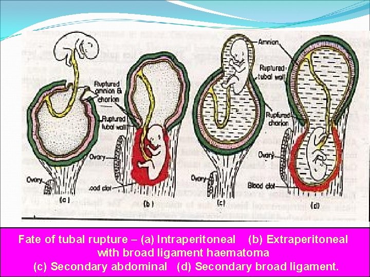 ECTOPIC PREGNANCY Dr Rupa Bajagain Kathmandu Medical College