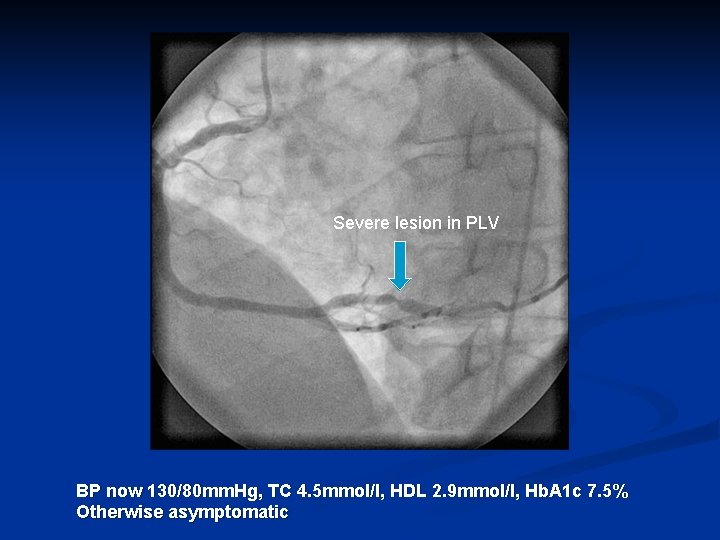 Investigations and Treatment for Stable Coronary Artery Disease