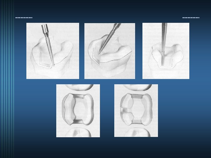 Cavity Preparation for Cast Metal Onlay No 275