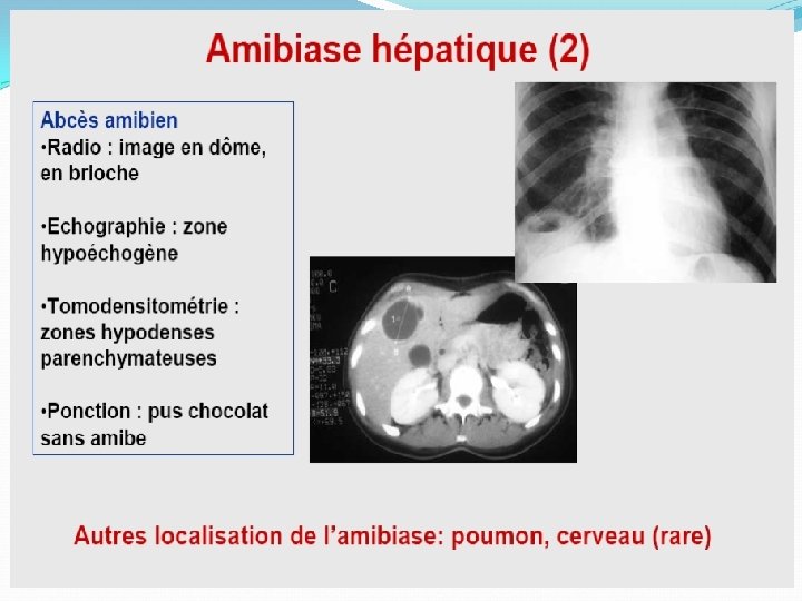 Diarrhes parasitaires Amibiase intestinale Entamoeba histolytica ...