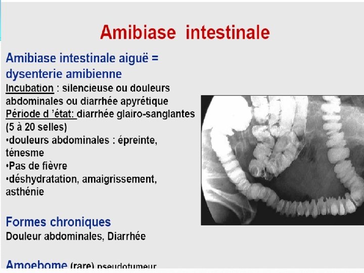 Diarrhes parasitaires Amibiase intestinale Entamoeba histolytica ...