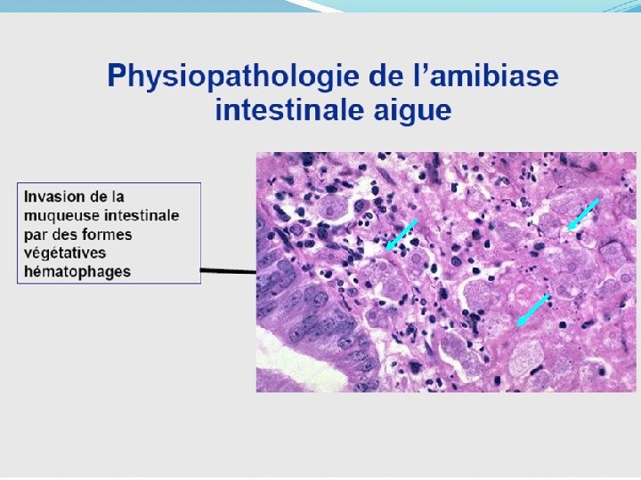 Diarrhes parasitaires Amibiase intestinale Entamoeba histolytica ...