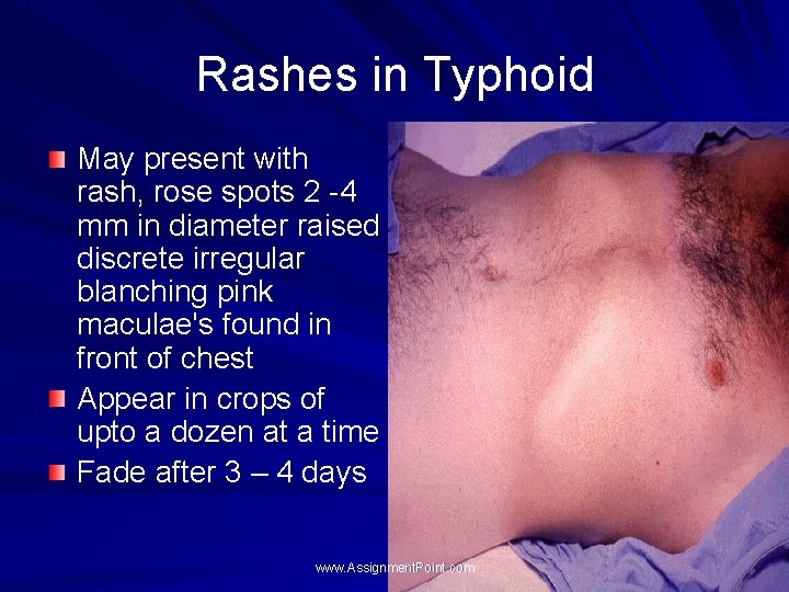 Presentation On Typhoid Fever www Assignment Point com