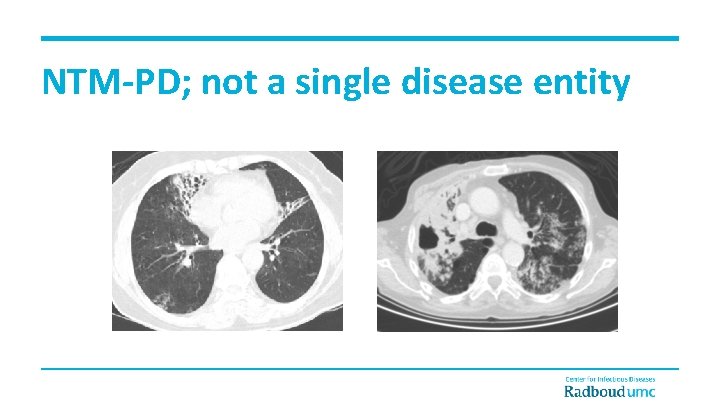 Treatment of nontuberculous mycobacterial pulmonary disease ...