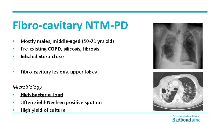 Treatment of nontuberculous mycobacterial pulmonary disease ...