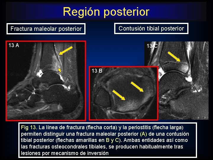 TIBIA Difuso fractura Superficie articular OCD Impingement osteoartrosis