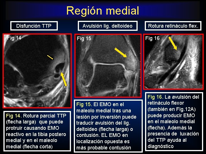 TIBIA Difuso fractura Superficie articular OCD Impingement osteoartrosis
