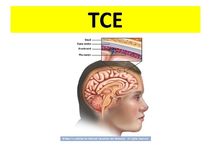 TRAUMATISMO CRANEO ENCEFALICO TCE CONCEPTO Es cualquier lesin