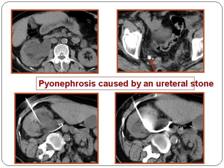 PERCUTANEOUS NEPHROSTOMY PLACEMENT UNDER CT GUIDANCE INDICATIONS TECHNIQUE