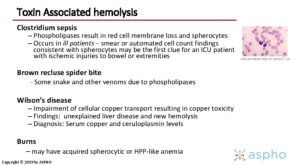 Congenital and Acquired Hemolytic Anemias Rachael Grace MD