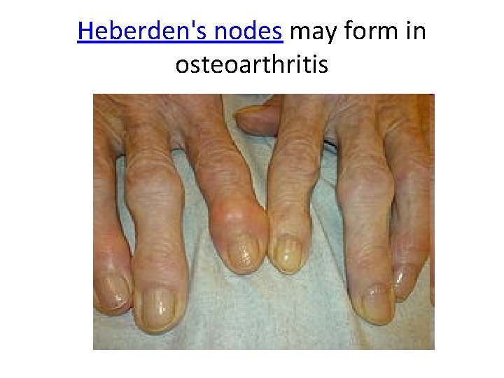 OSTEOARTHRITIS Osteoarthritis OA is a common degenerative disease