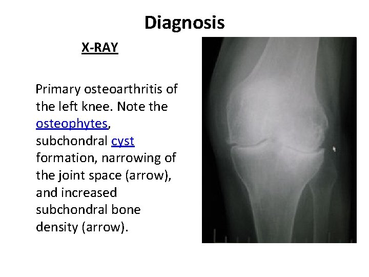 OSTEOARTHRITIS Osteoarthritis OA is a common degenerative disease