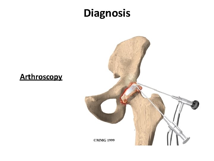OSTEOARTHRITIS Osteoarthritis OA is a common degenerative disease