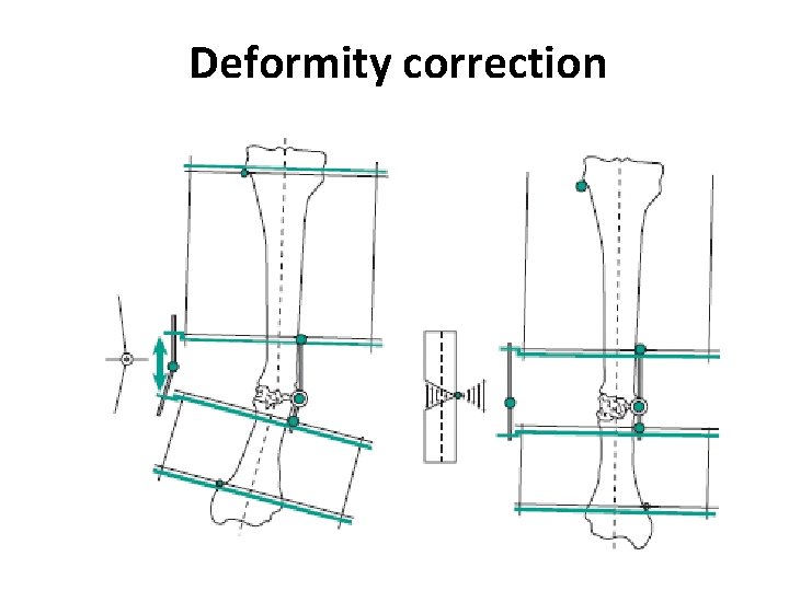 OSTEOARTHRITIS Osteoarthritis OA is a common degenerative disease