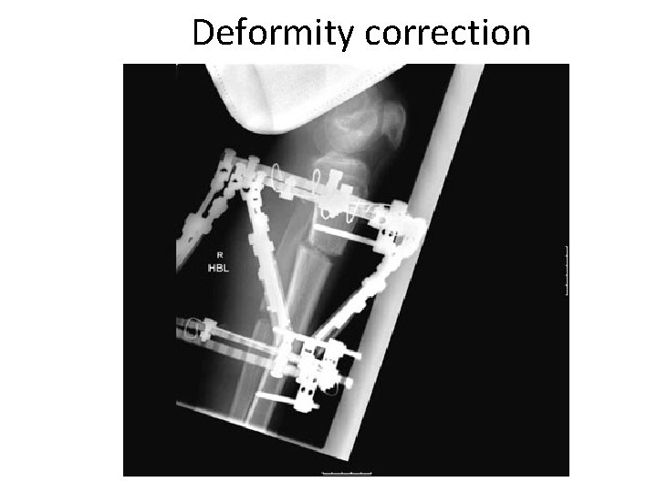 OSTEOARTHRITIS Osteoarthritis OA is a common degenerative disease