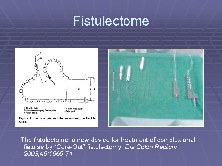 Treatment for Anal fistula Dr Wong Siu Wang