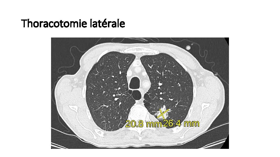 Chirurgie Thoracique la rvolution silencieuse Drs Axel AUBERT
