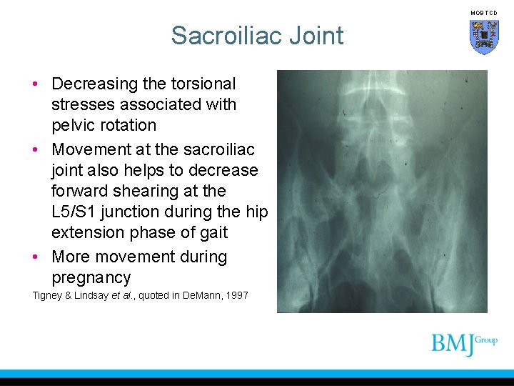 MOB TCD Pubic Symphysis and Sacroiliac Joint Professor