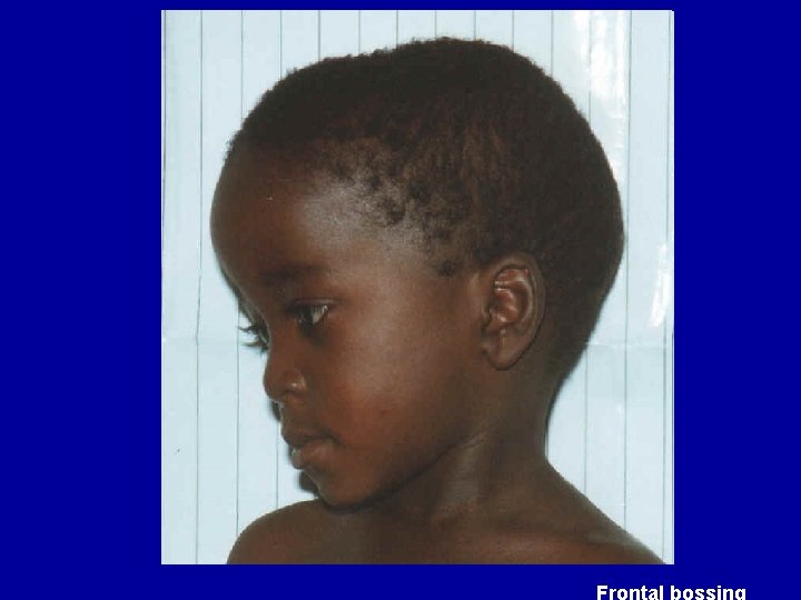 RICKETS Rickets Definition Failure of mineralisation of the