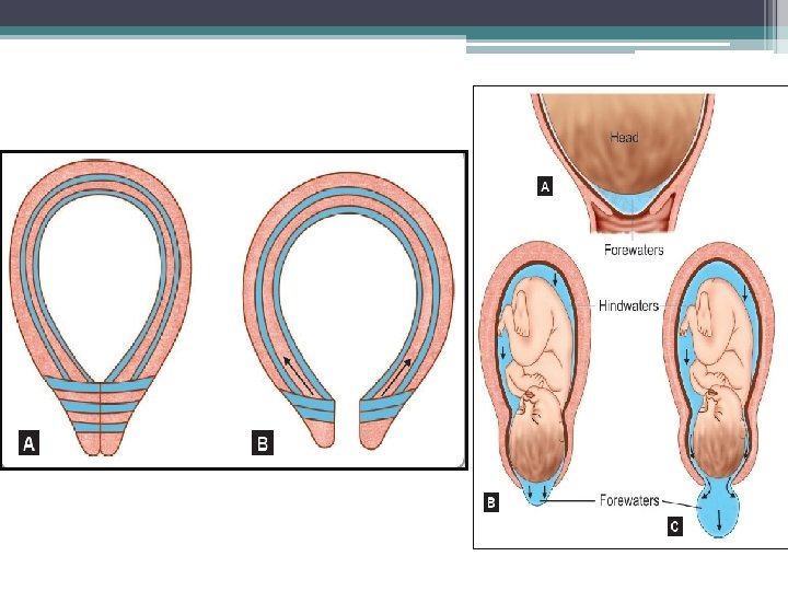 PRELABOR RUPTURE OF MEMBRANES PROM Dr Vishal Chaudhari