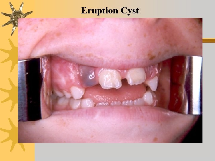 DEVELOPMENT of the DENTAL TISSUE INDUCTION ORAL Epith